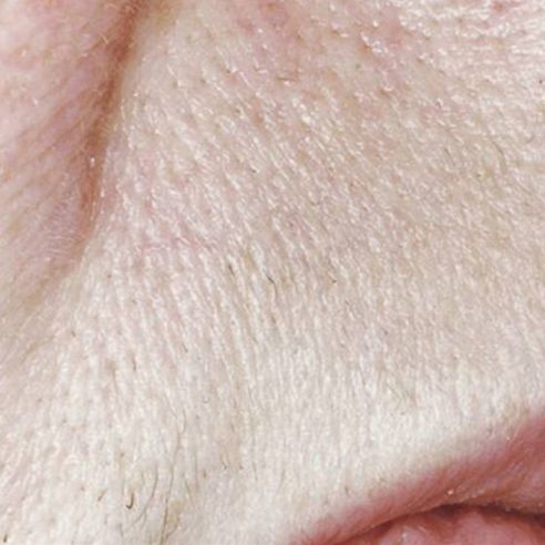 Elite iQ™ | Skin Revitalization & Laser Hair Reduction | Cynosure ME